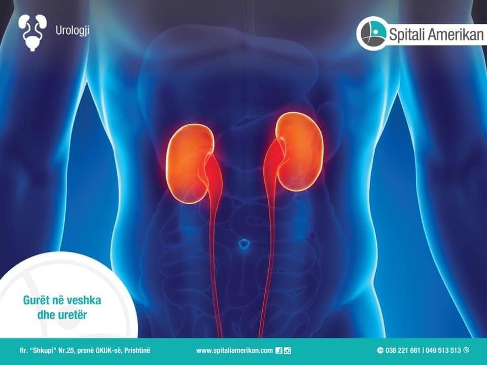 GURËT NË VESHKA DHE URETËR - Gazeta Express