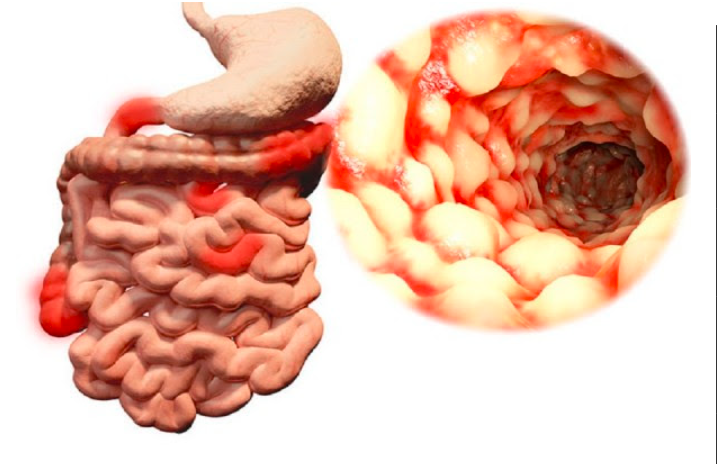 Shenjat e para se kjo sëmundje po jua shkatërron zorrët - Gazeta Express