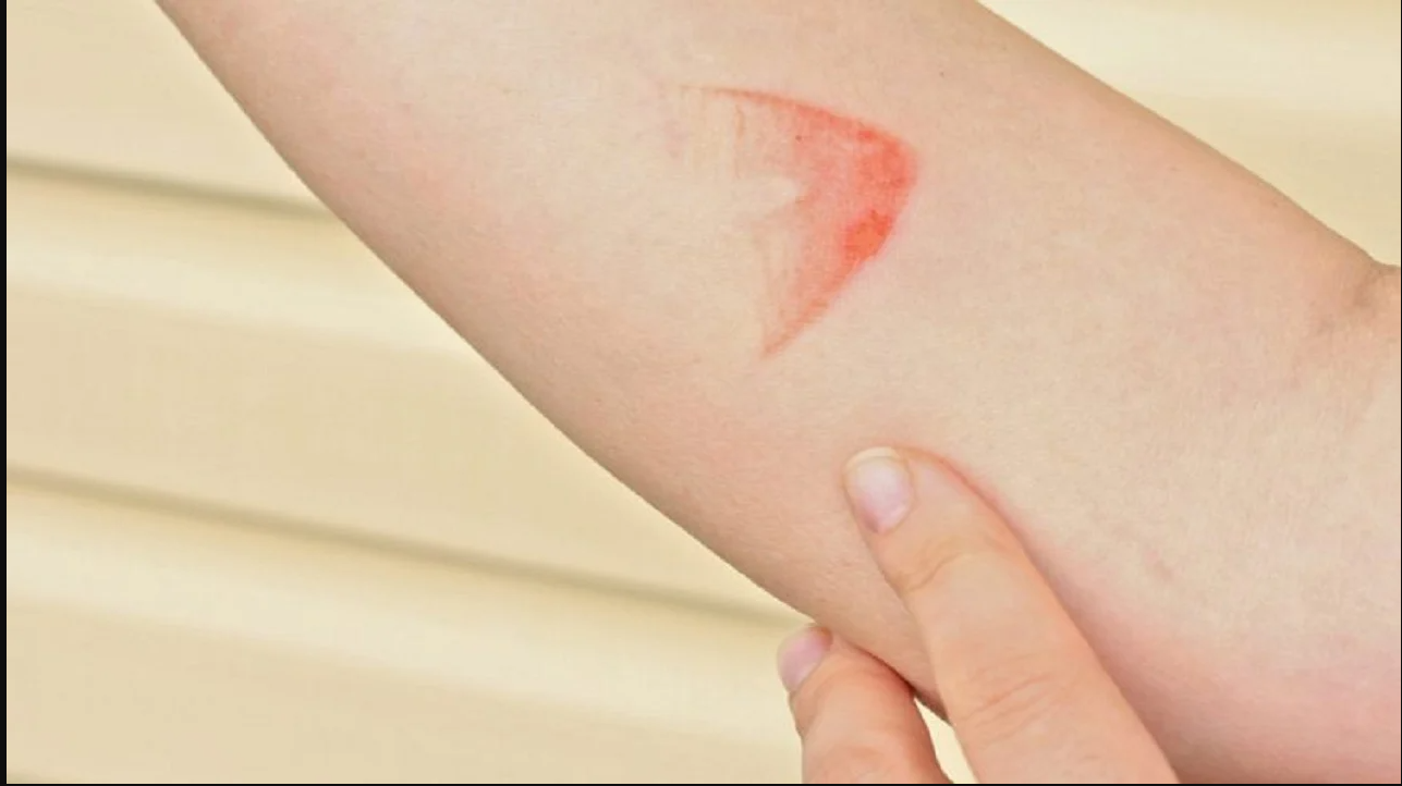 Përse nuk duhet të vendosësh akull mbi lëkurën e djegur - Gazeta Express