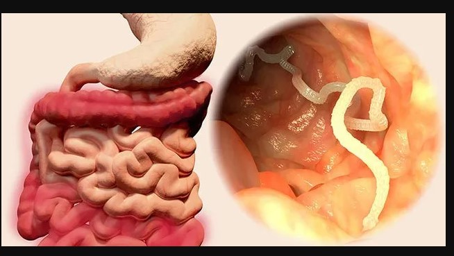 Këto produkte eliminojnë parazitët e zorrës te fëmijët - Gazeta Express