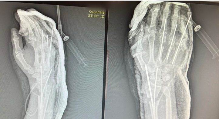 Rast i rrallë, pacientit 27 vjeç i shpëtohet parakrahu i prerë në QKUK ...
