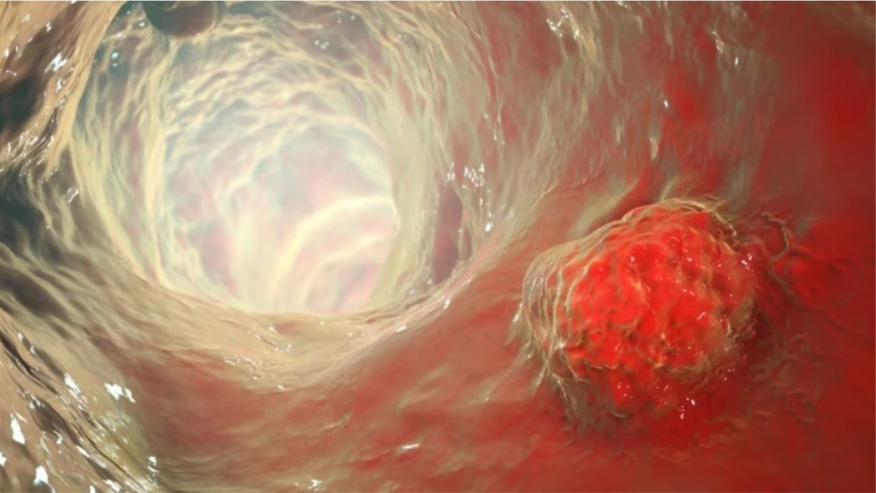 Historike: Zbulohet qeliza kyçe që lufton kancerin e zorrës së trashë ...