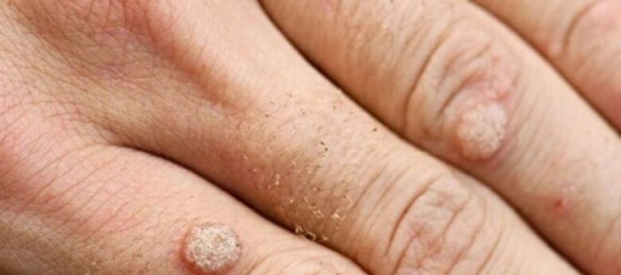 Pse shfaqen lythat dhe si mund ti parandaloni! - Gazeta Express