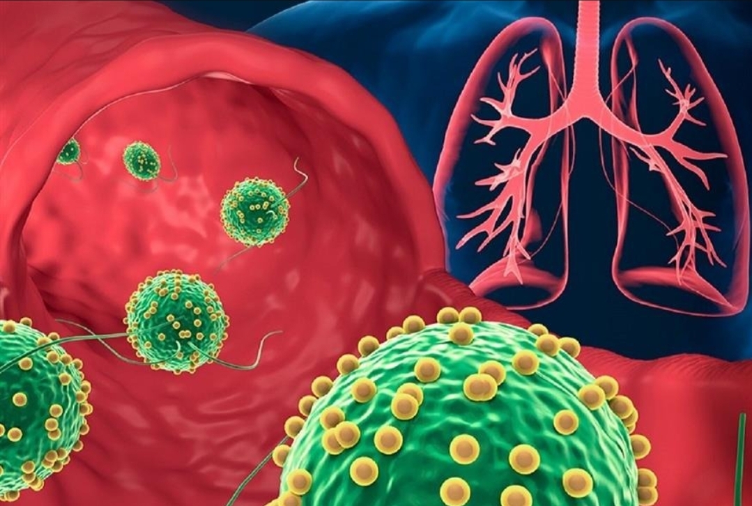 Mikrobi i ri që sulmon mushkëritë dhe pritet "të përhapet" edhe më ...