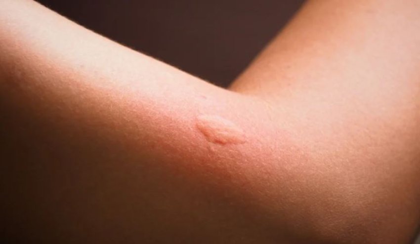 Si të mbroni lëkurën e fëmijës tuaj nga pickimi i insekteve ...